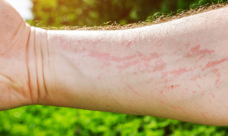 Urticaria Crónica (ronchas) – guía para los que sufren - La Asociación ...