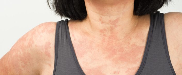 Itching or Hives? | Asthma & Allergy Associates of Florida
