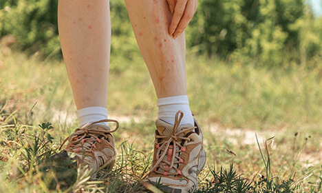 Insect Sting Allergies | Asthma & Allergy Associates of Florida