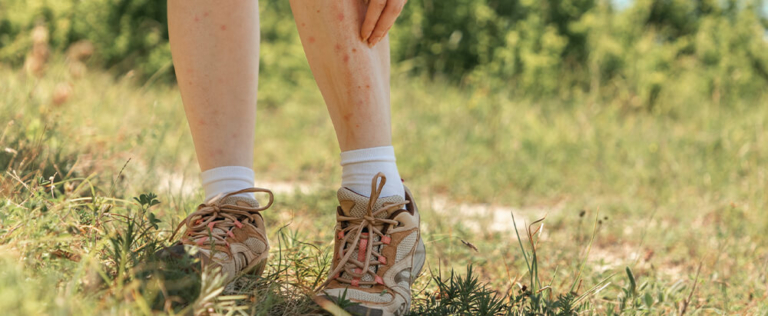 Insect Sting Allergies | Asthma & Allergy Associates of Florida